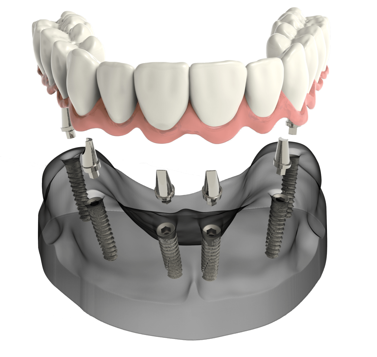 Dentures Baltimore | Partial & Implant Dentures